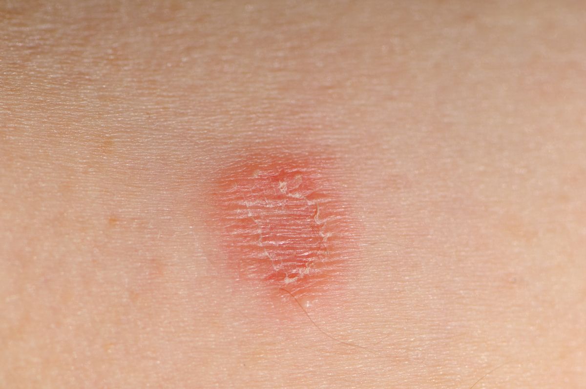 These Pictures Will Help You Identify the Most Common Skin Rashes
