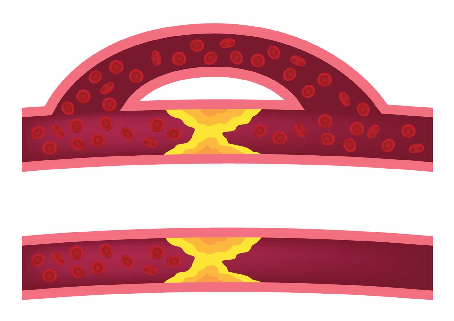 What is peripheral artery disease, and are you at risk?