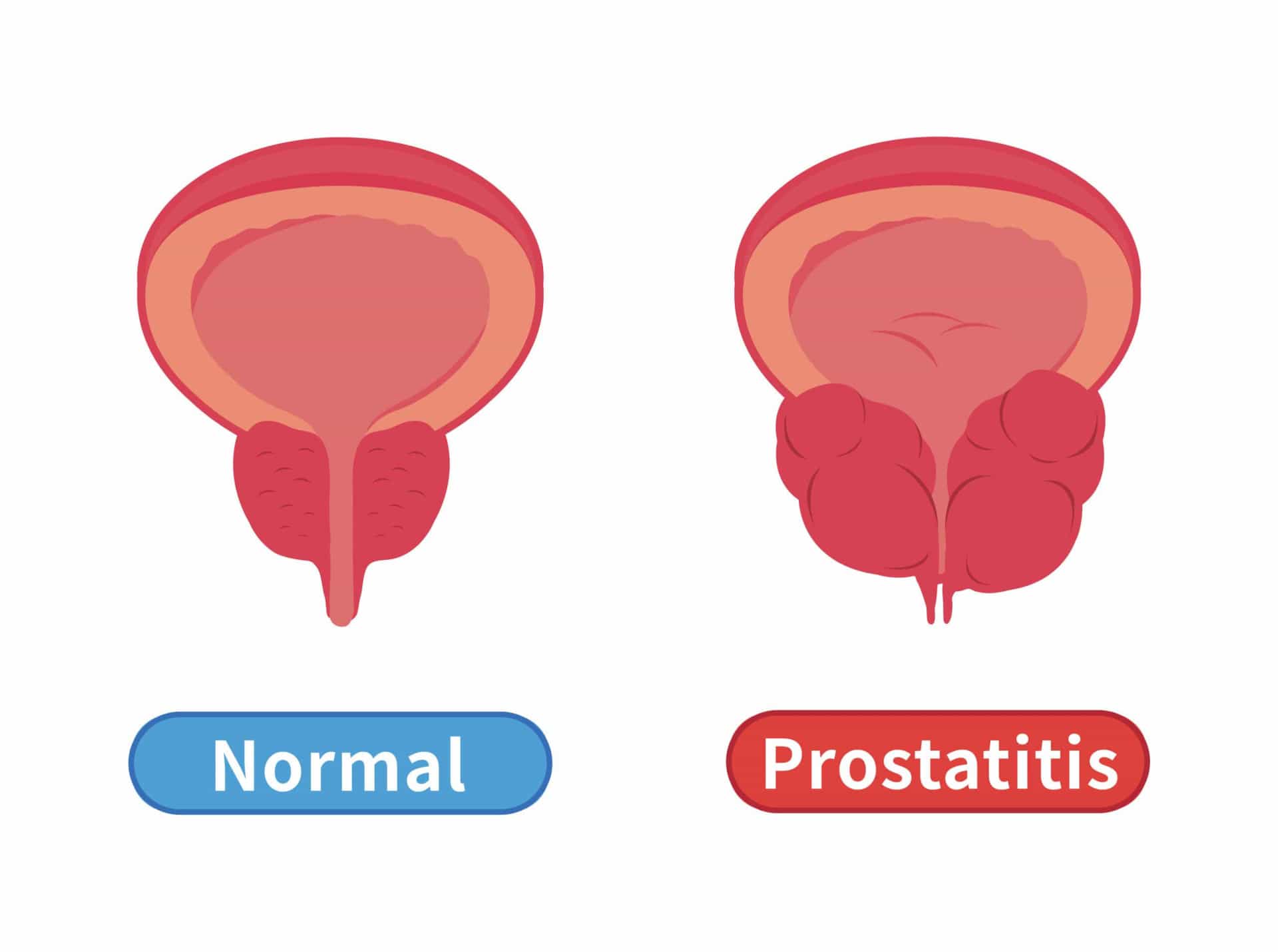 Important facts about prostate cancer