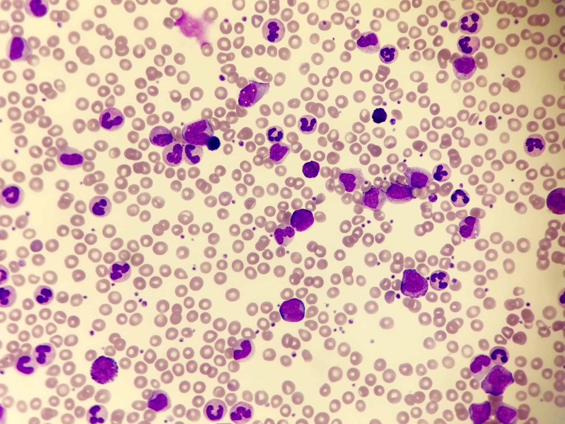 Rare cancers that challenge the medical profession