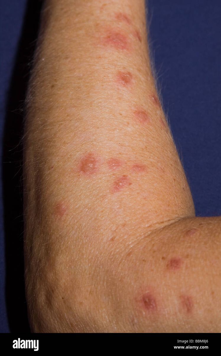 These Pictures Will Help You Identify the Most Common Skin Rashes