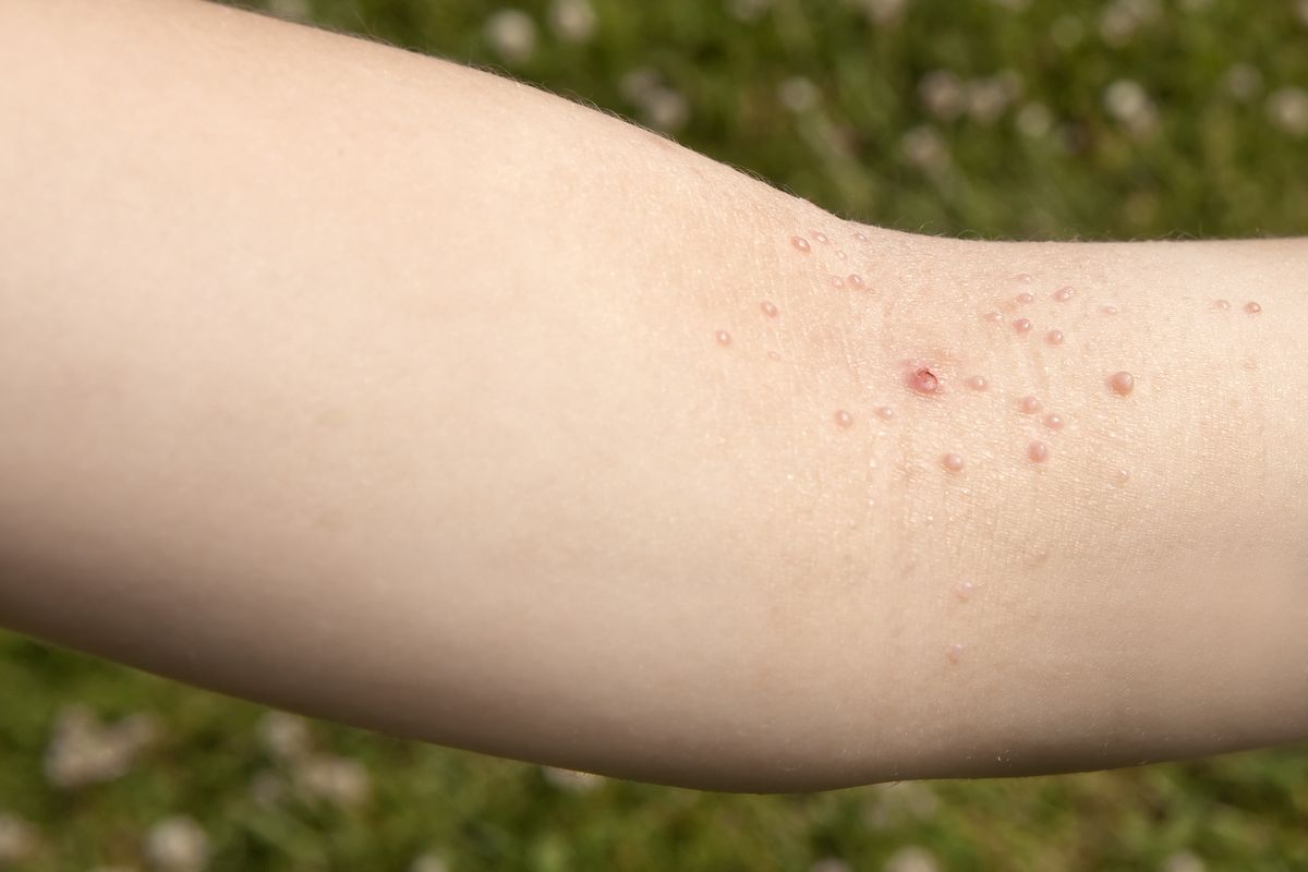 These Pictures Will Help You Identify the Most Common Skin Rashes