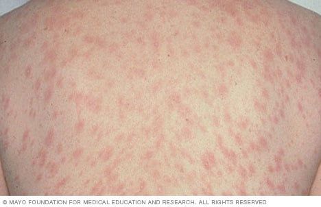 These Pictures Will Help You Identify the Most Common Skin Rashes