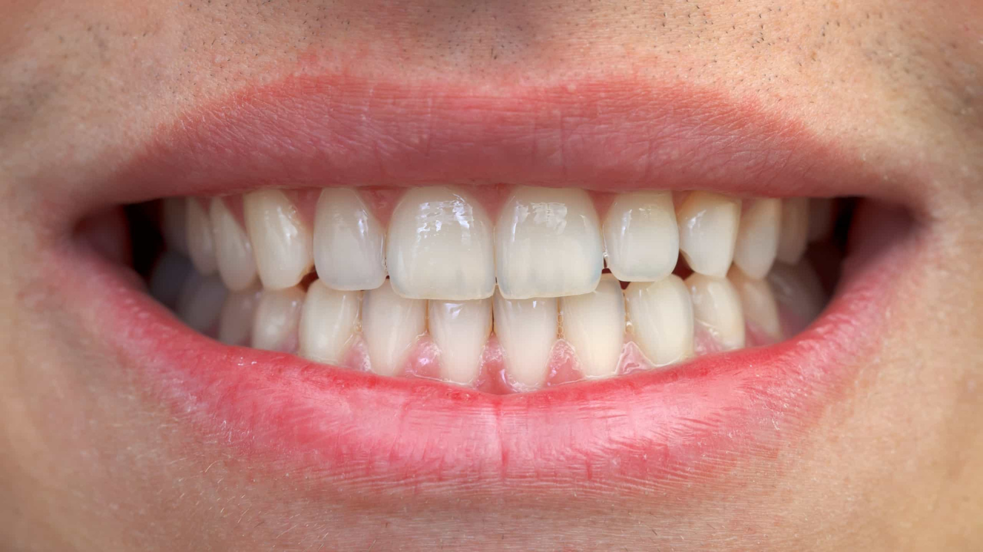 Astuces pour des dents plus blanches et un sourire éclatant