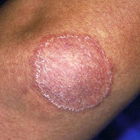 7 at-home treatments to clear ringworm quickly