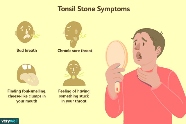 Tonsil Stones (Tonsilloliths): Causes, Symptoms, and Treatment