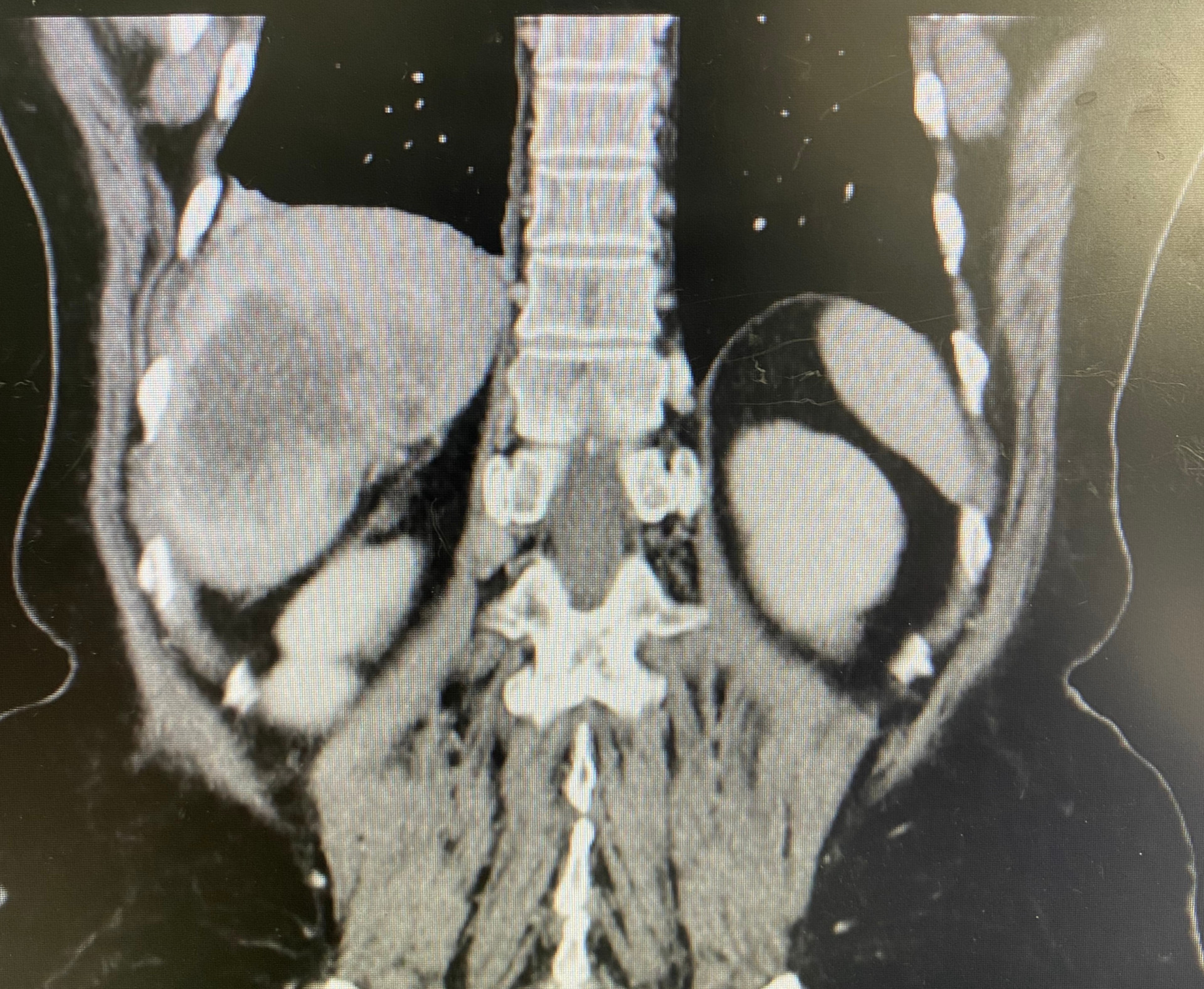 Cholangiocarcinoma: the bile duct cancer with a low survival rate