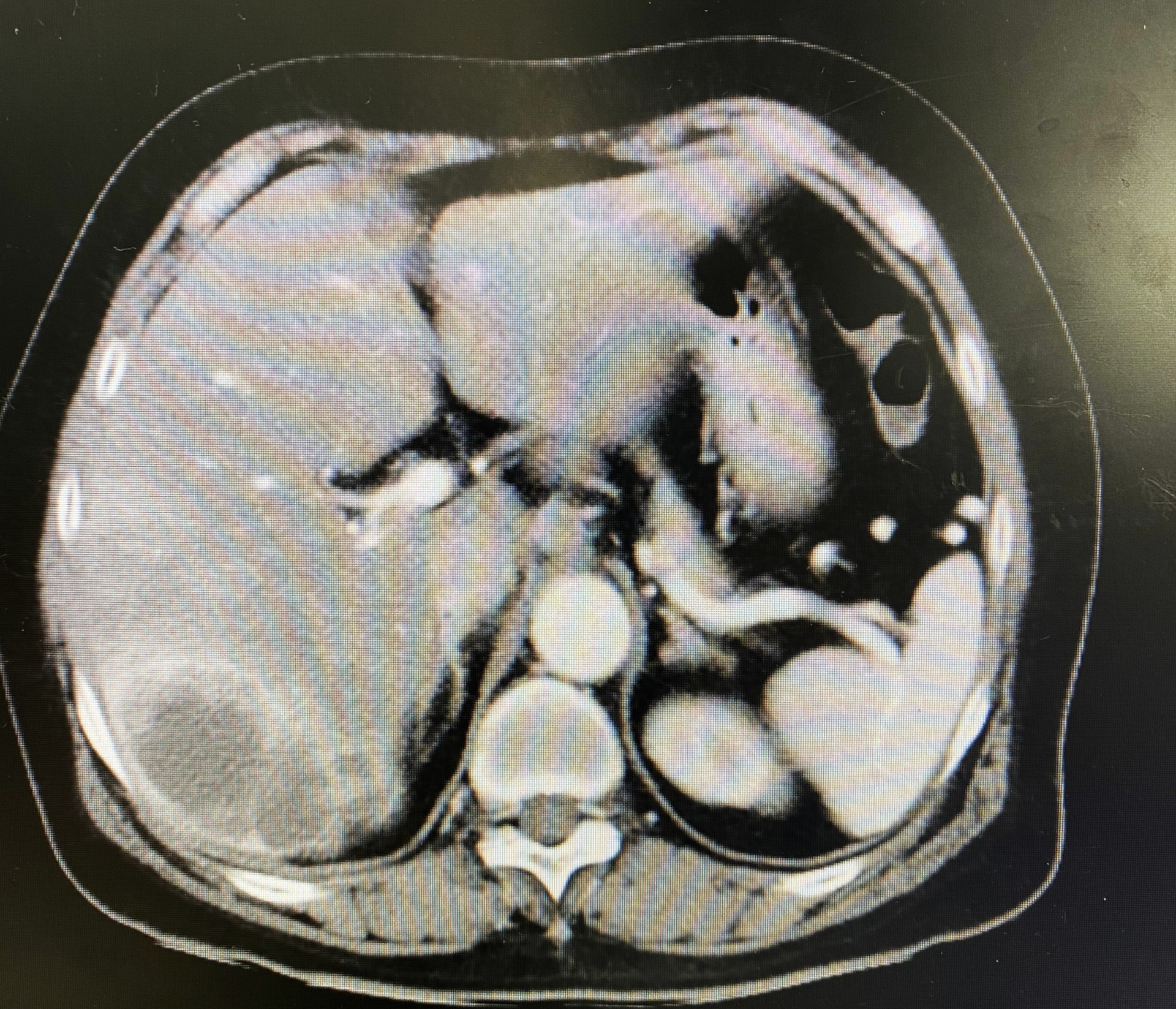 Cholangiocarcinoma: the bile duct cancer with a low survival rate