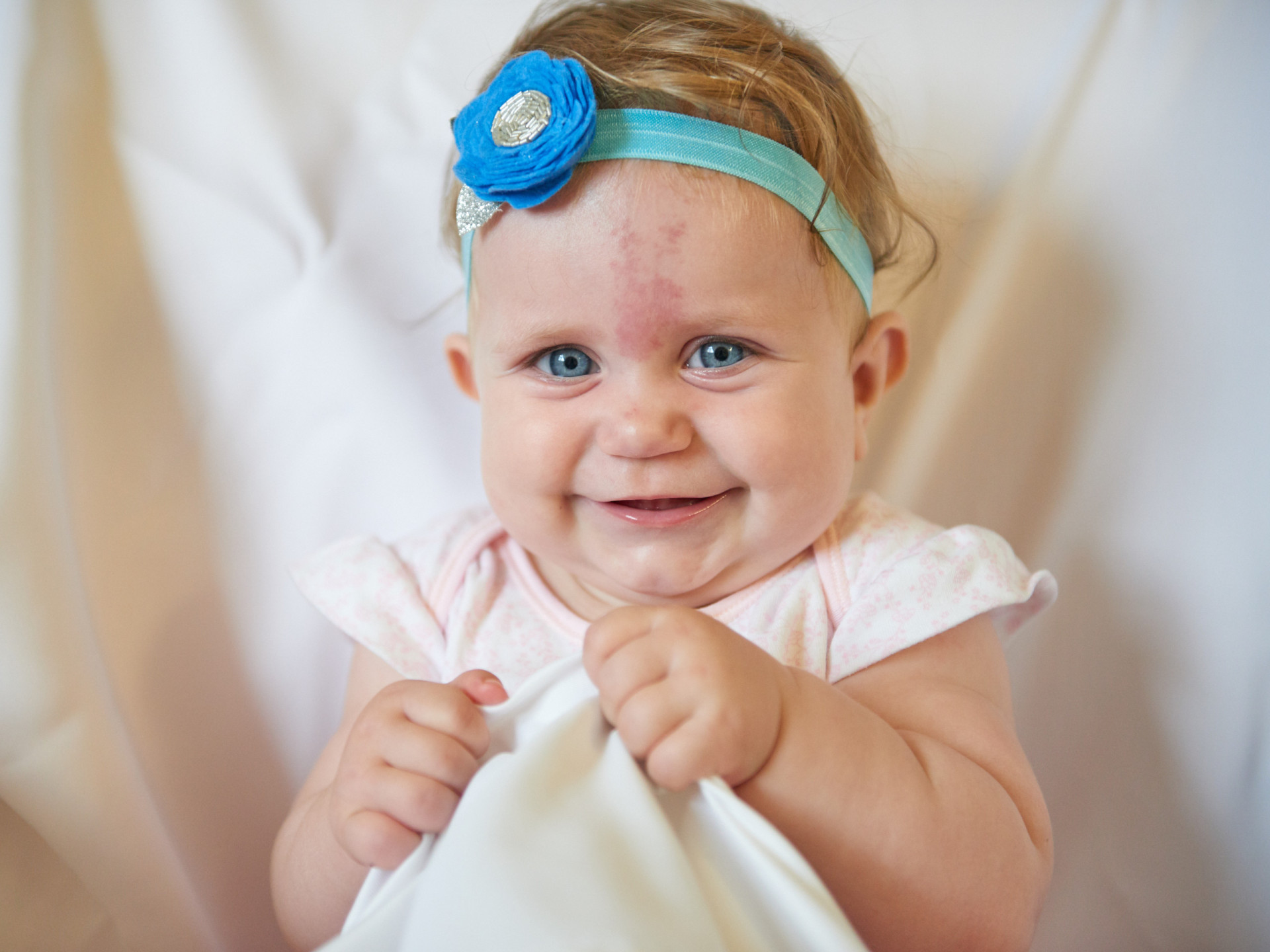 Birthmarks and the celebrities who embrace theirs