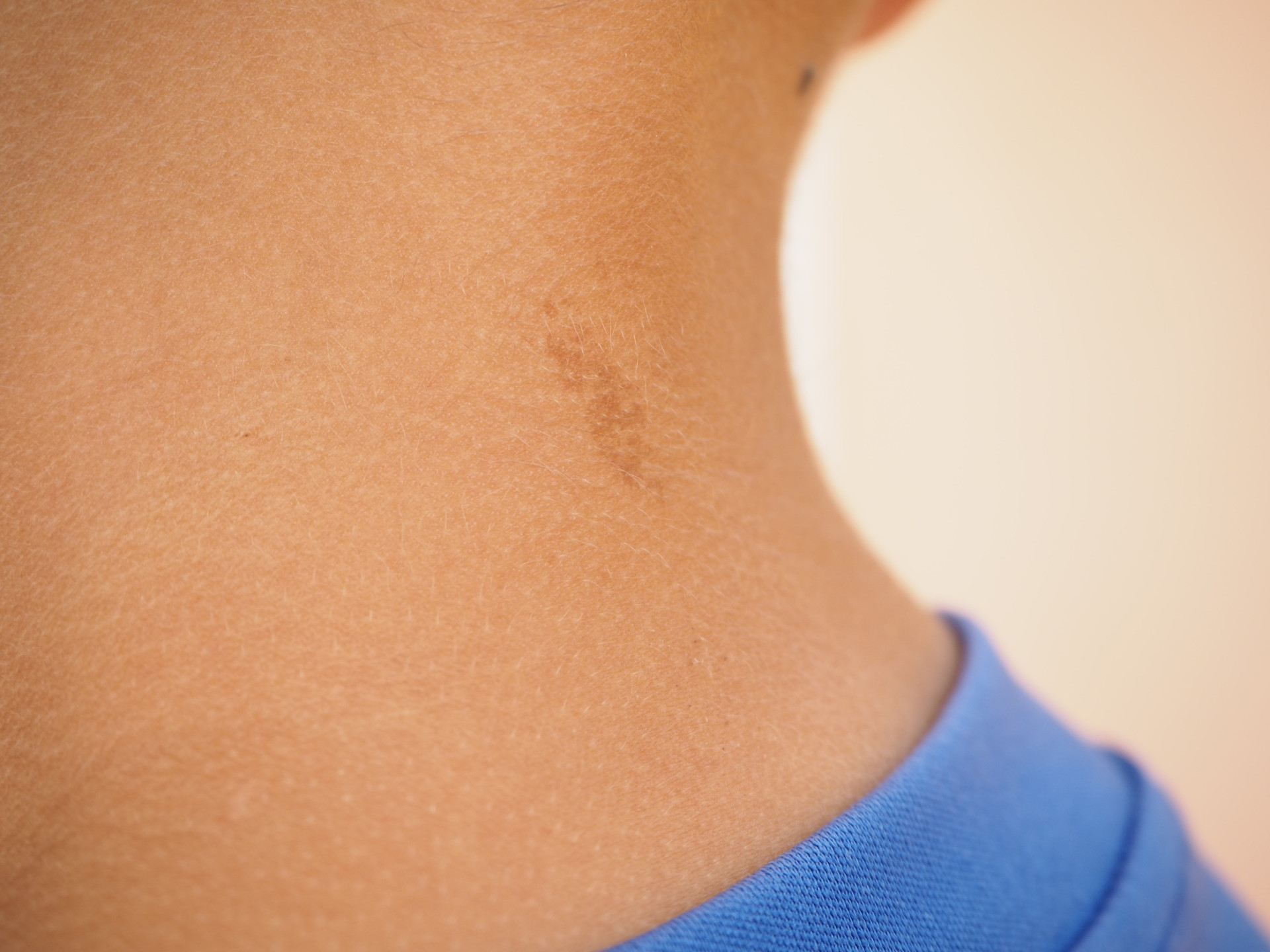 Birthmarks and the celebrities who embrace theirs