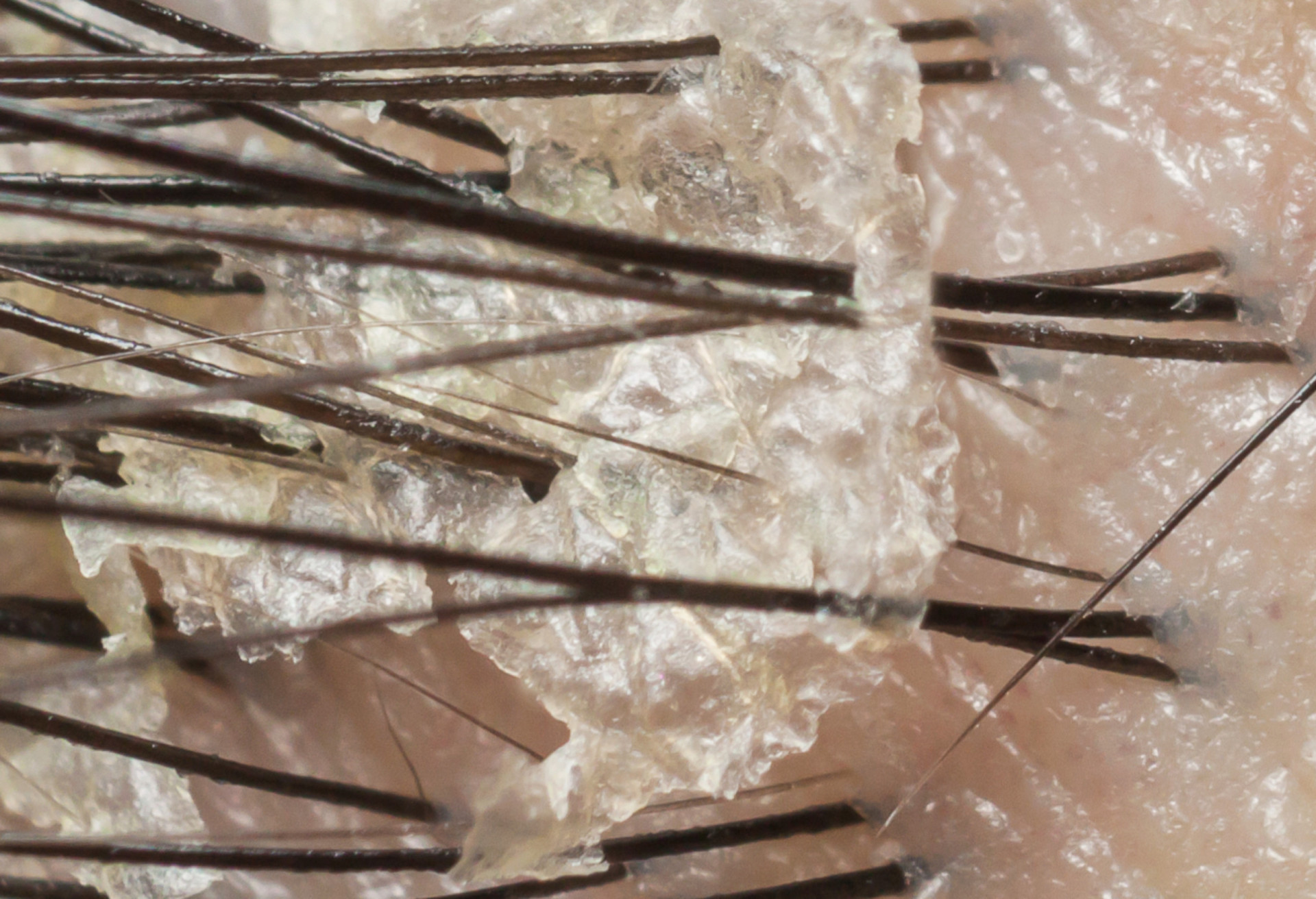 Here's how to really deal with dandruff