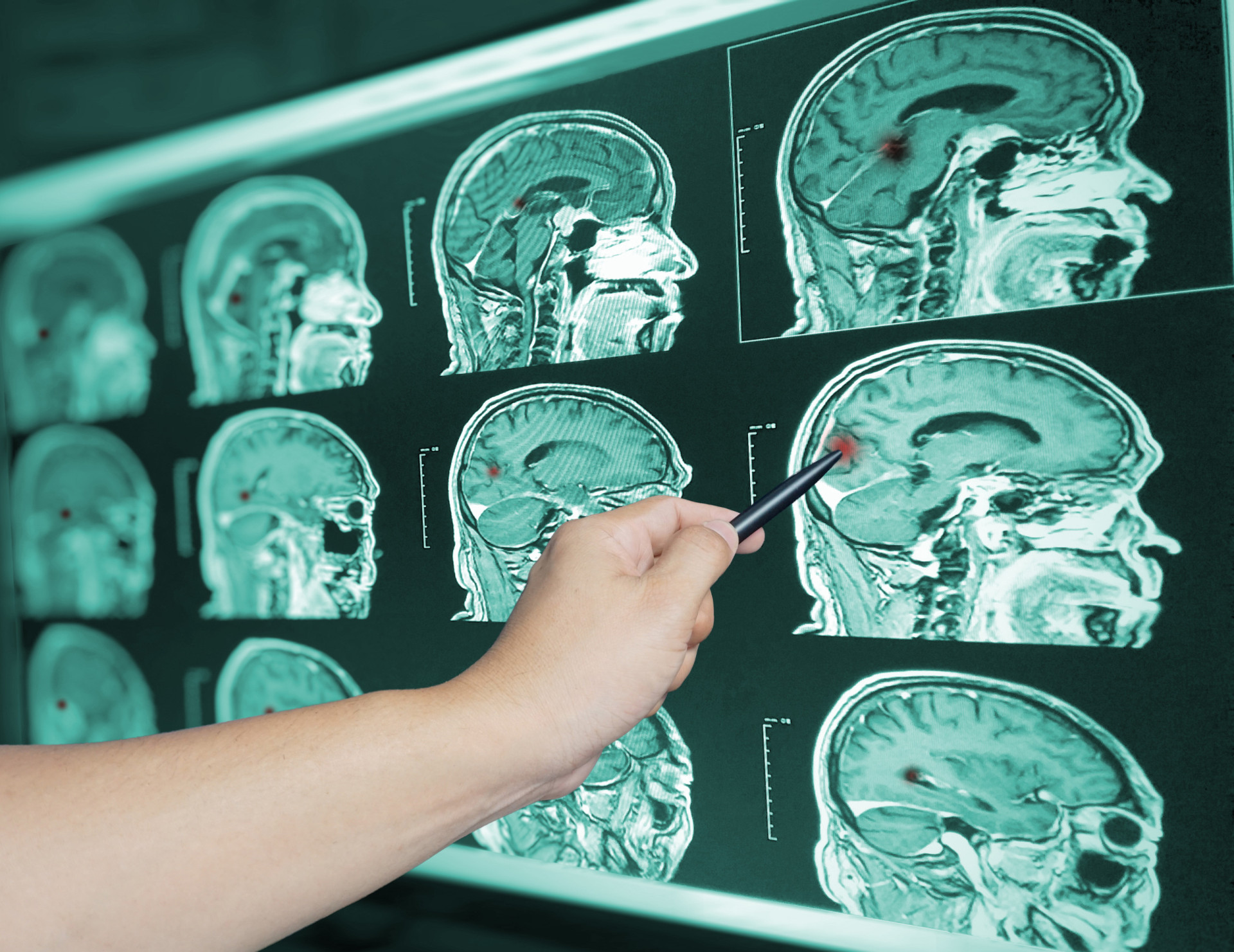Just how serious is traumatic brain injury?
