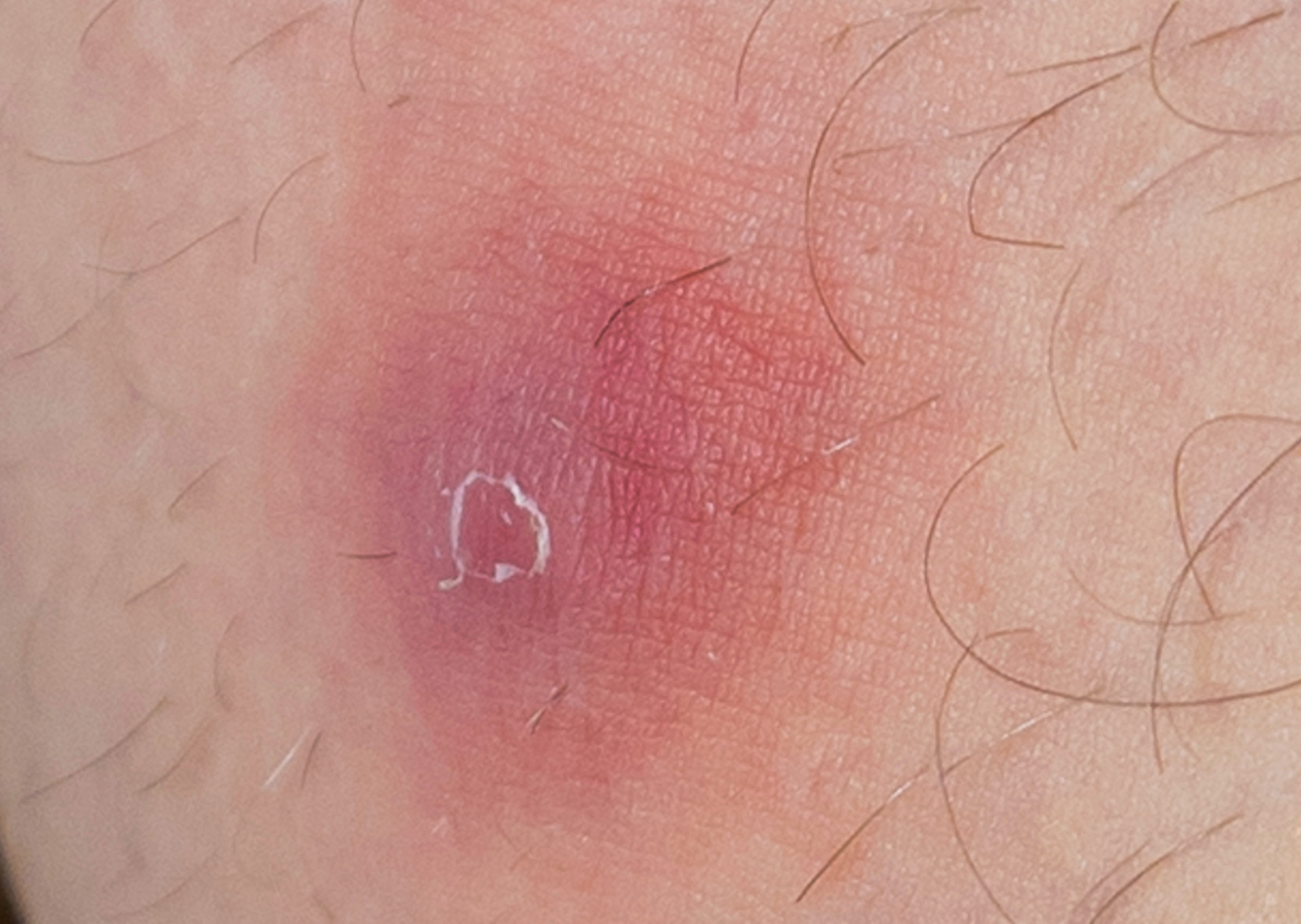 How serious is the inflammatory condition known as sarcoidosis?