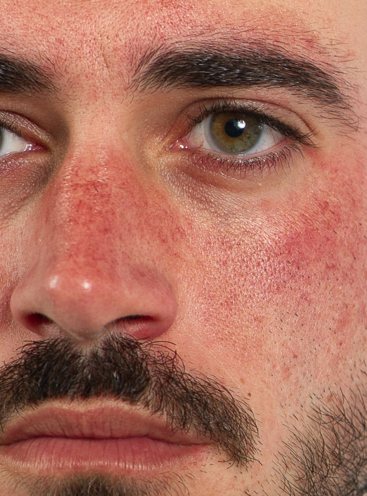 Facing up to the skin condition called rosacea