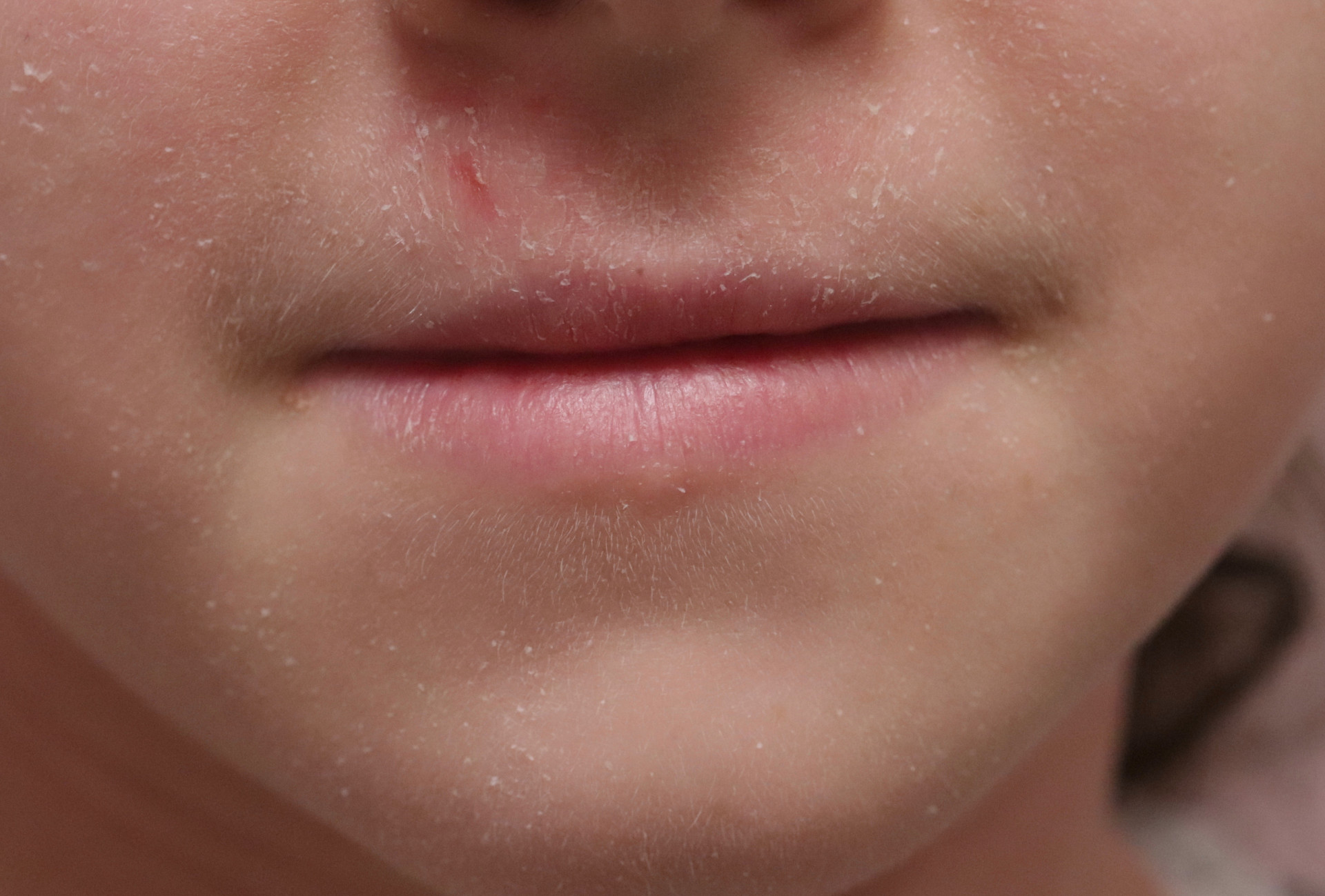 Facing up to the skin condition called rosacea