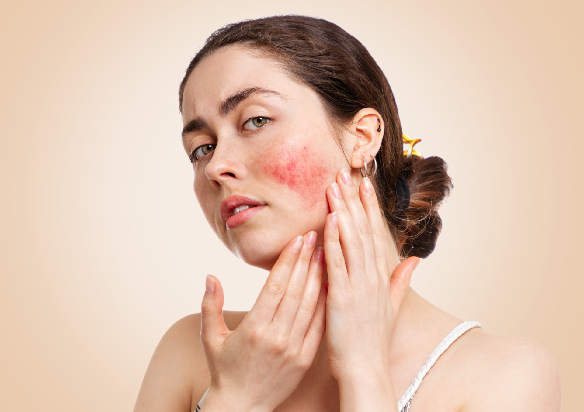 Facing up to the skin condition called rosacea