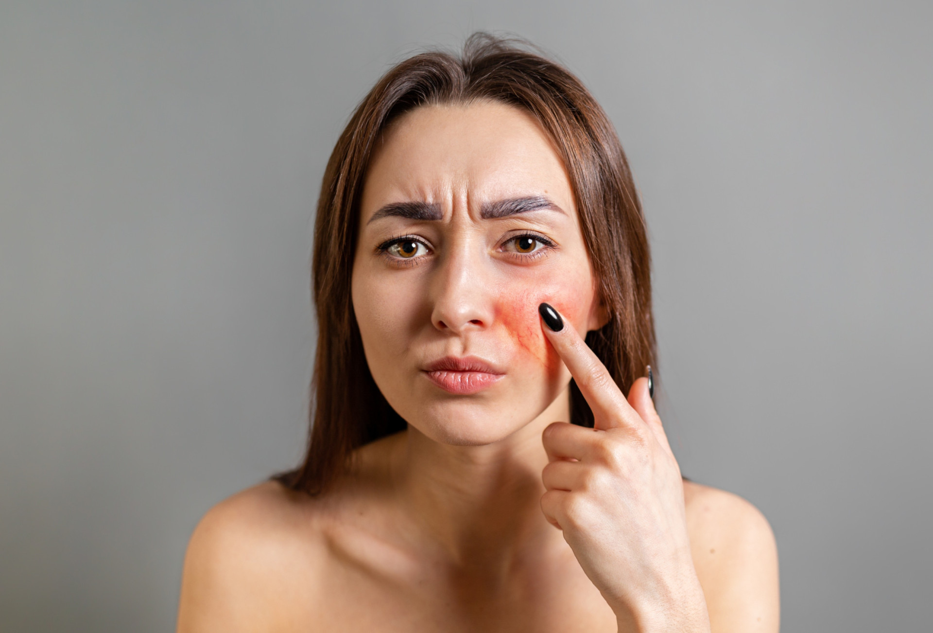 Facing up to the skin condition called rosacea