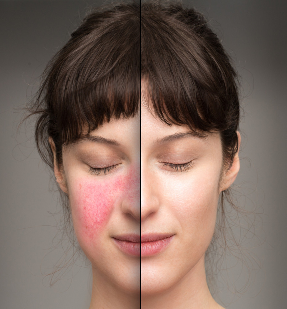 Facing up to the skin condition called rosacea