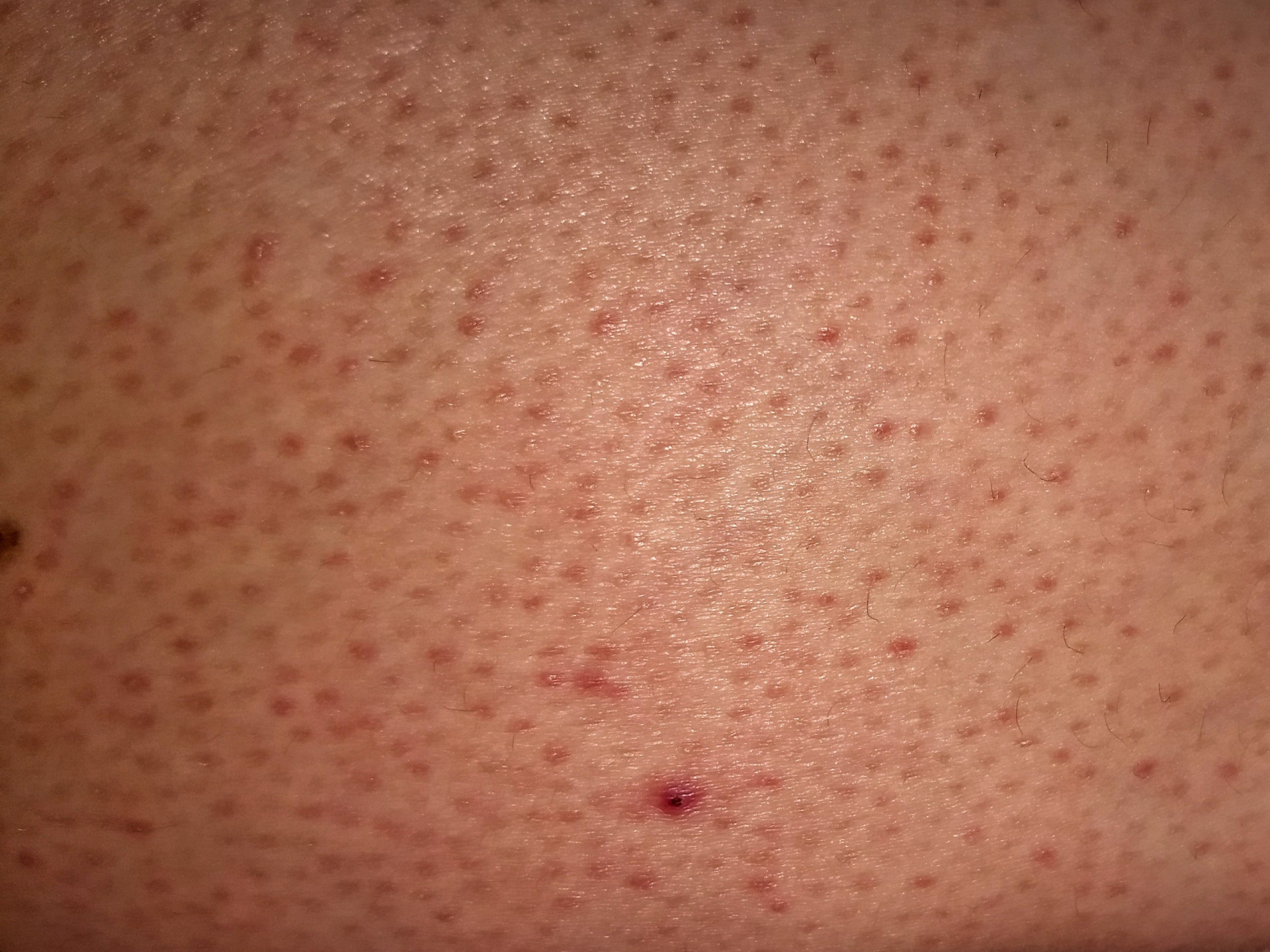 Facing up to the skin condition called rosacea