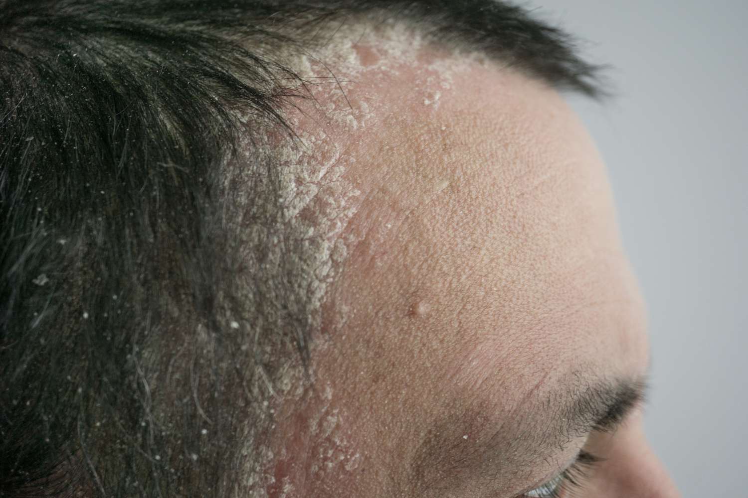 Understanding Scalp Psoriasis and How to Treat It