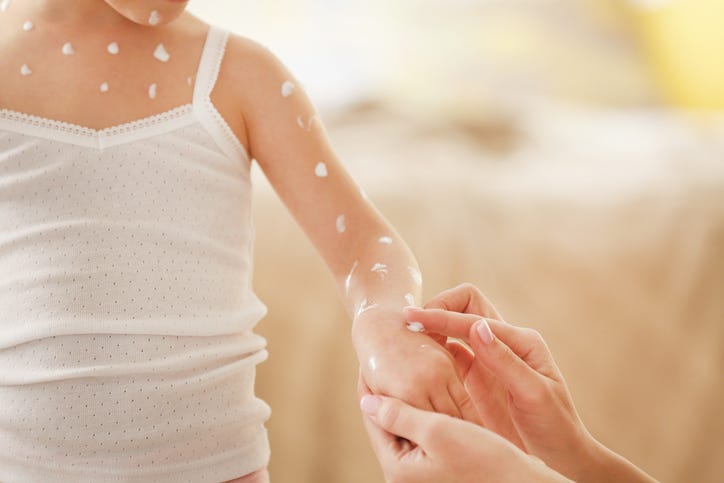 Chickenpox outbreak keeps unvaccinated children home from Spartanburg ...