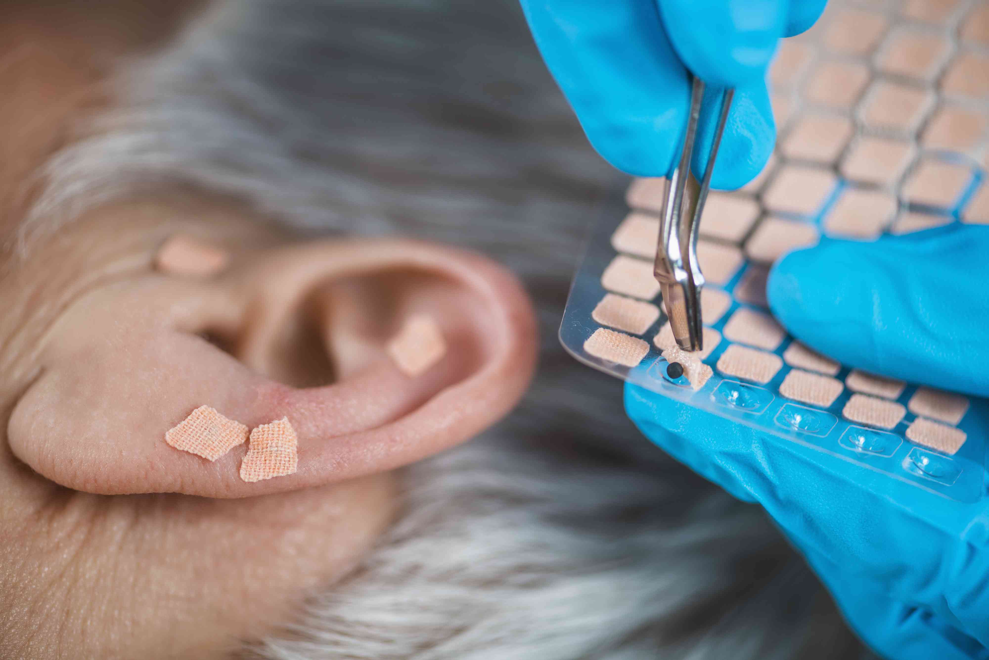Ear Seeds: What to Know About This Acupressure Therapy