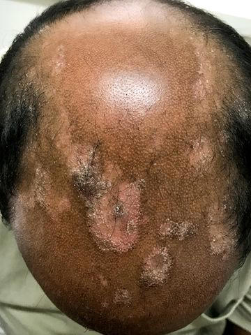 Understanding Scalp Psoriasis and How to Treat It