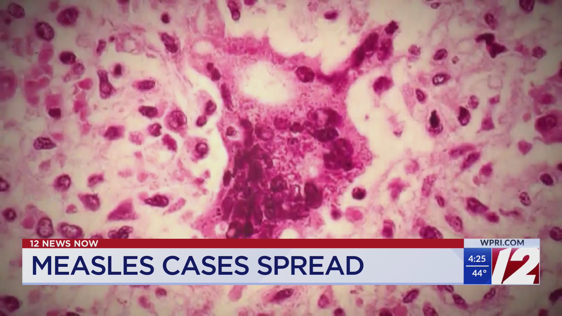 Texas measles cases rise to 146 in an outbreak that led to a child's death