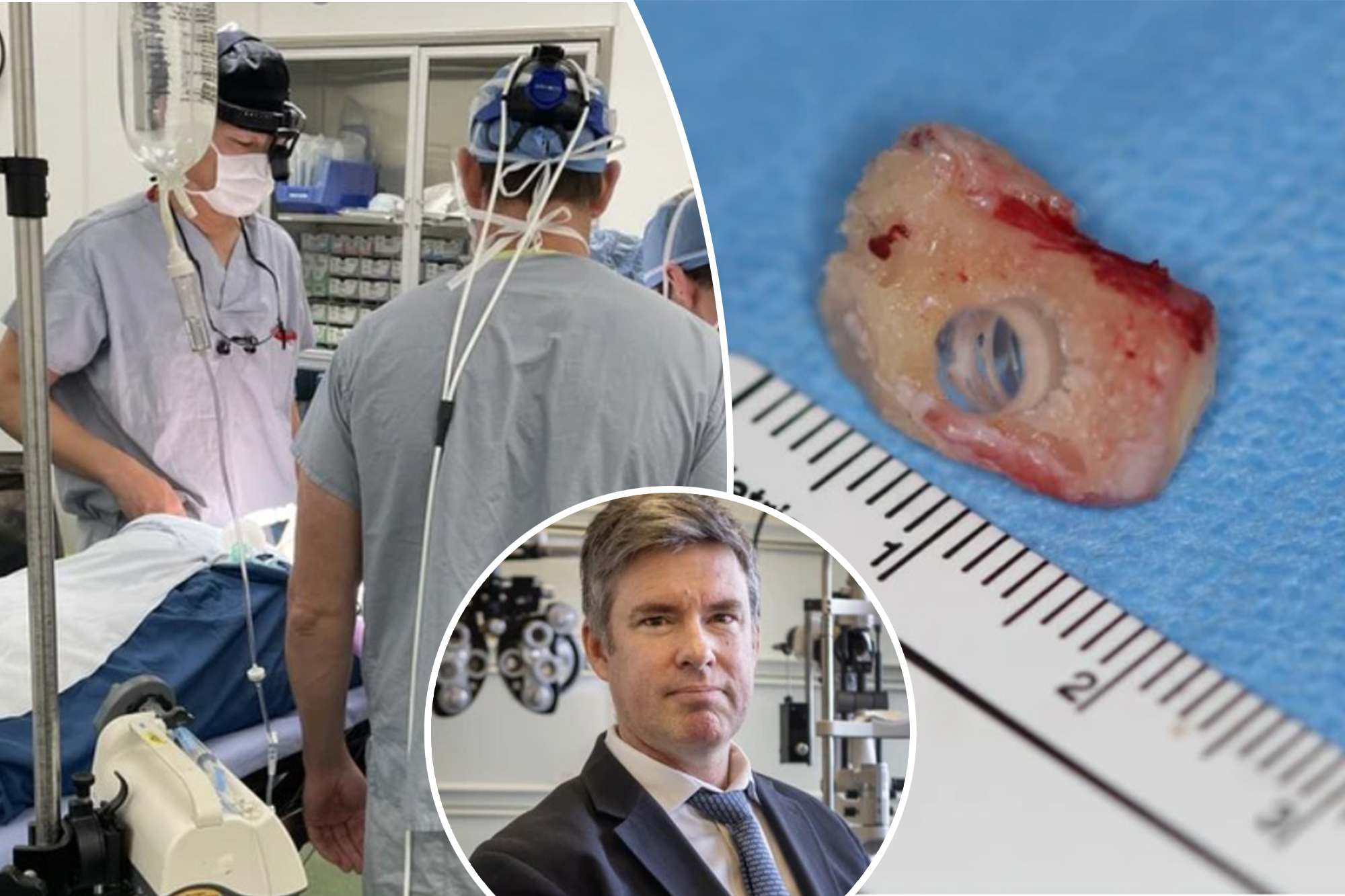 Blind Canadian man has his own tooth surgically implanted in his eye to ...