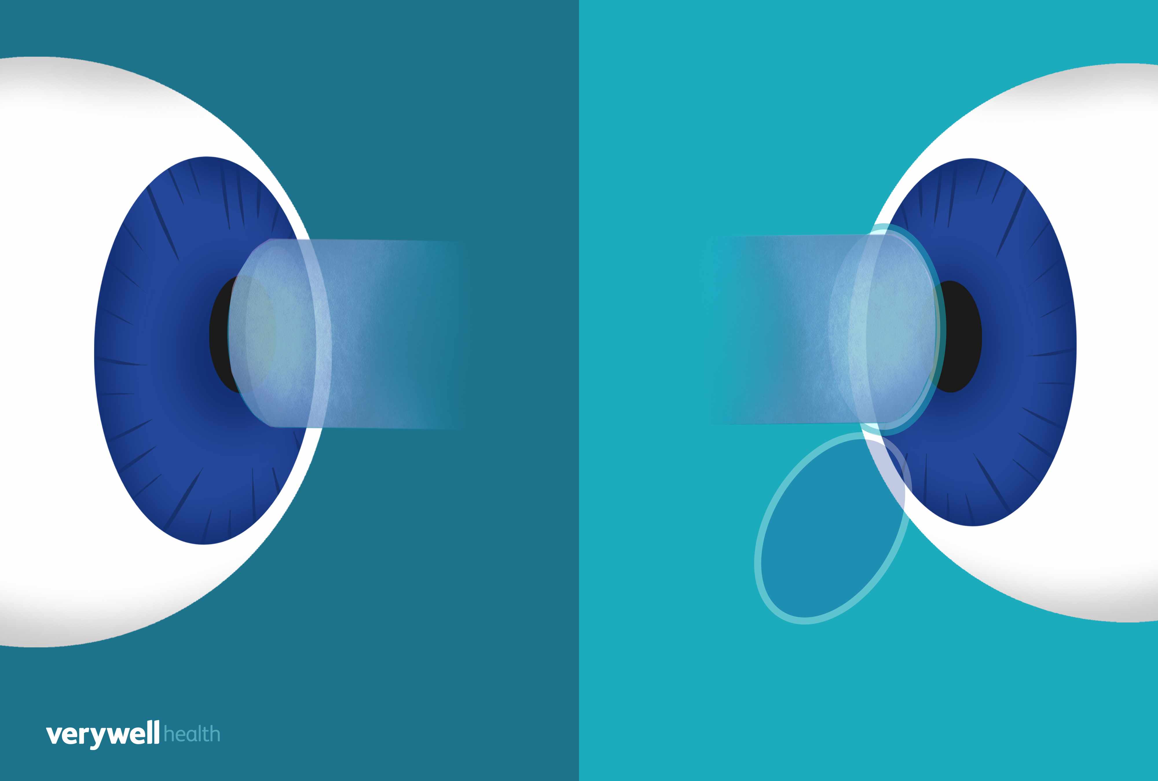 Comparing PRK vs. LASIK Eye Surgery Results and Side Effects