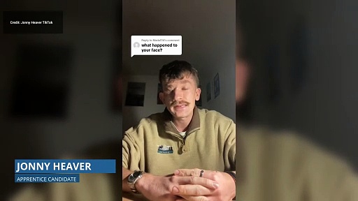 The Apprentice's Jonny opens up about cause of his facial scars