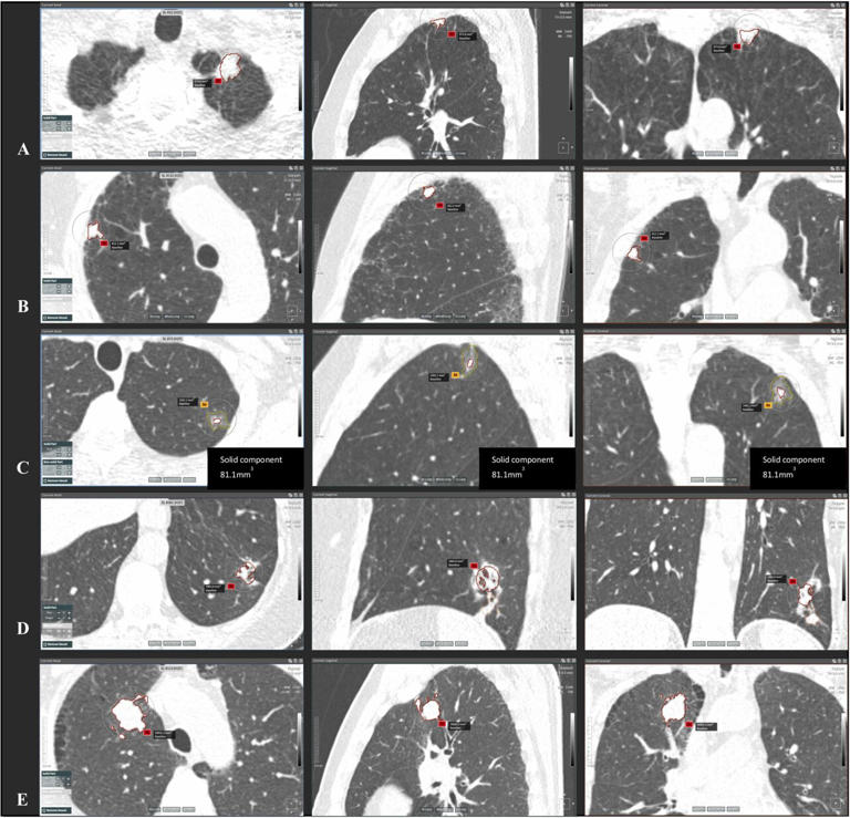 AI successfully reduces workload in lung cancer screening