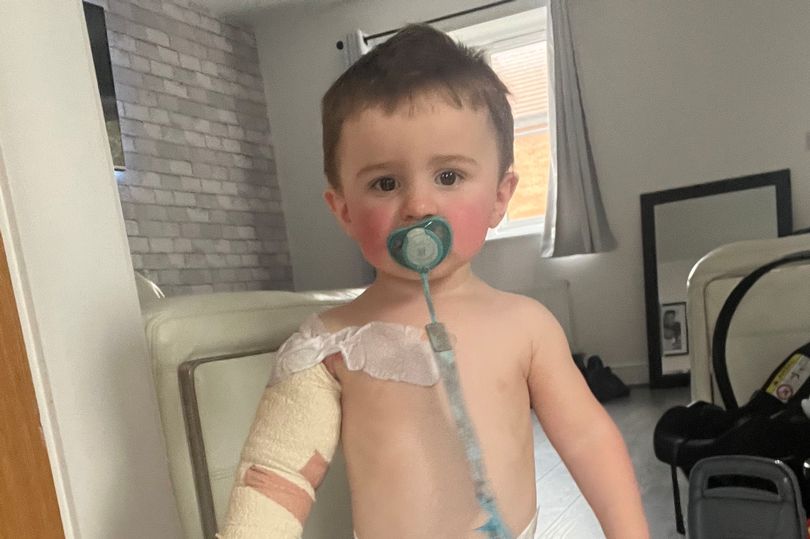 Toddler left with huge scar after surgeon mistake during routine operation