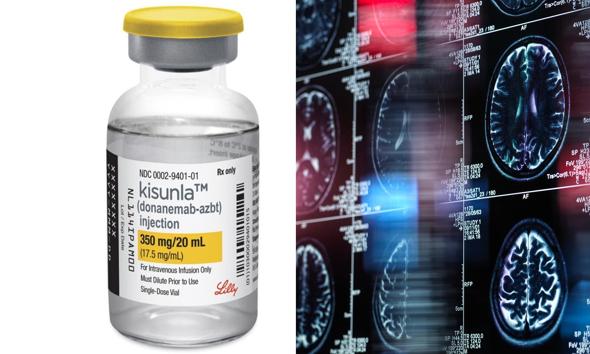 Brain bleeds in up to a third of those on 'miracle' dementia drug