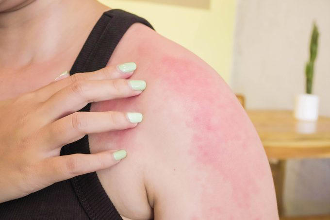 11 Signs Your Sunburn Is Actually Sun Poisoning, According to Expert ...