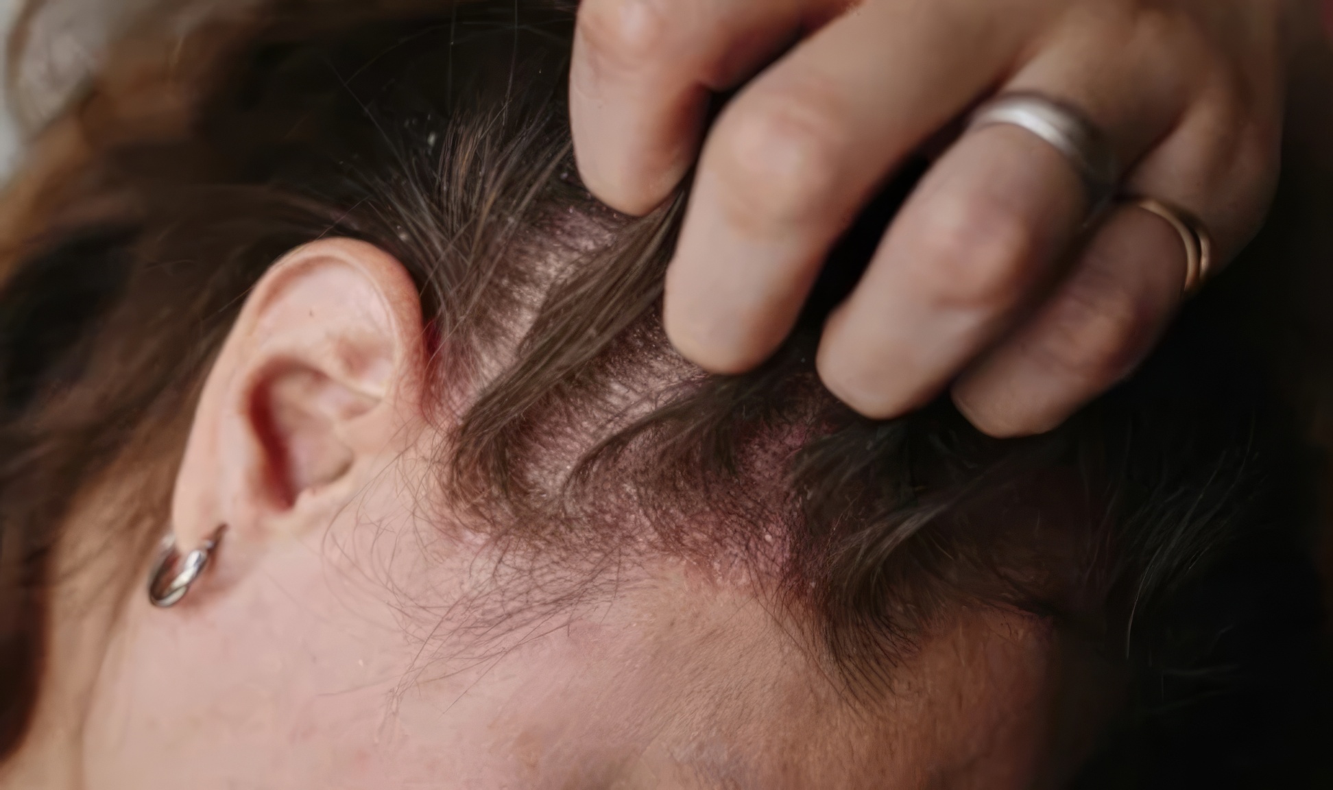 8 remèdes naturels pour combattre l’eczéma et retrouver le confort