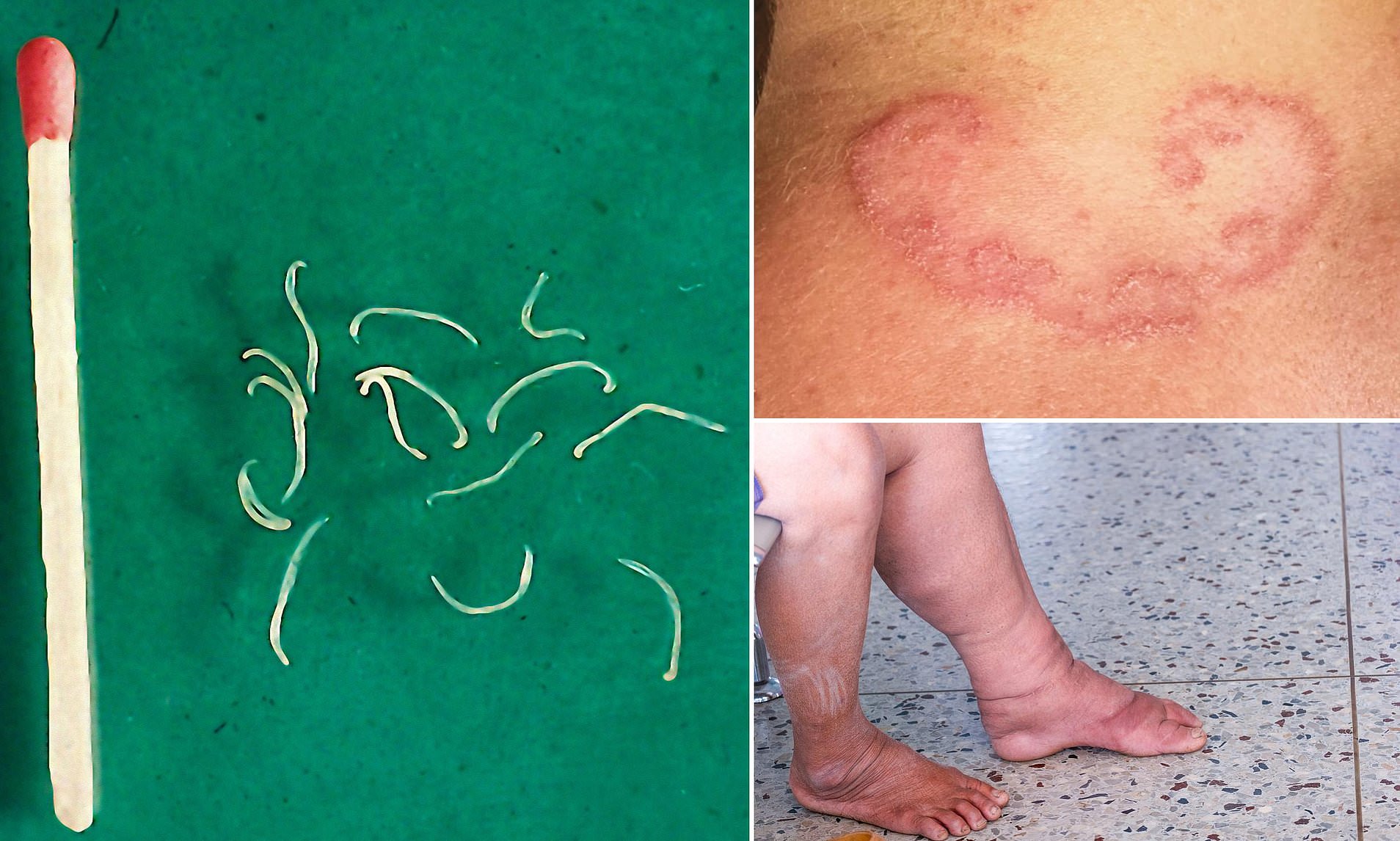 Gut symptom affecting millions could be hidden sign of parasites