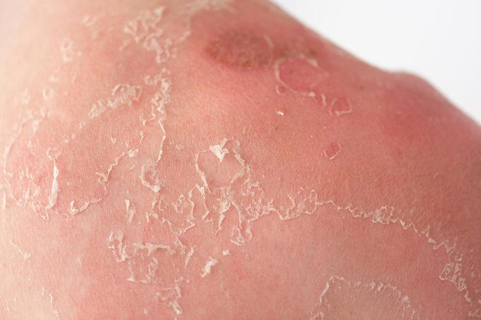 11 Signs Your Sunburn Is Actually Sun Poisoning, According to Expert ...