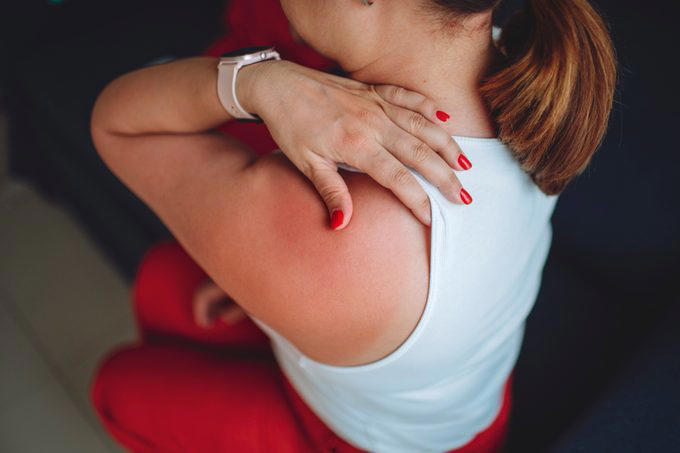11 Signs Your Sunburn Is Actually Sun Poisoning, According to Expert ...