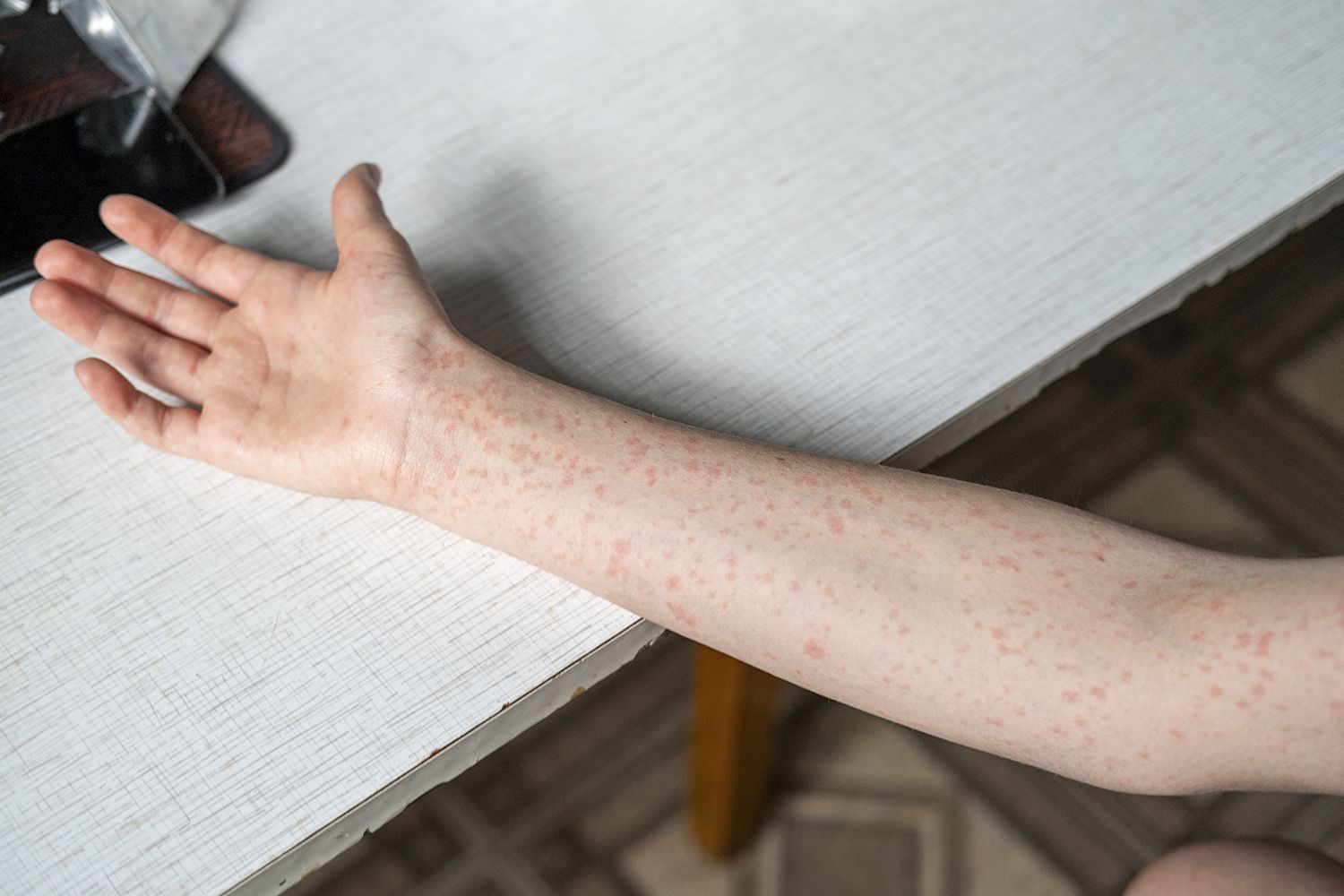 'Measles Parties' for Kids Are 'Terrifying' — and Could Have ...