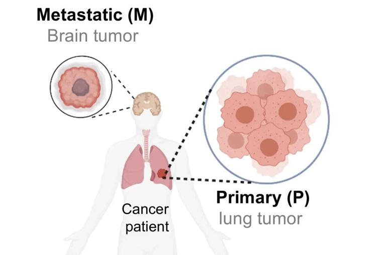 Natural defense mechanism may help slow down tumor cell metastasis