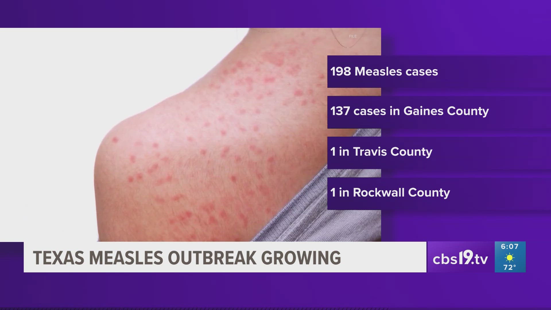 Texas measles outbreak growing