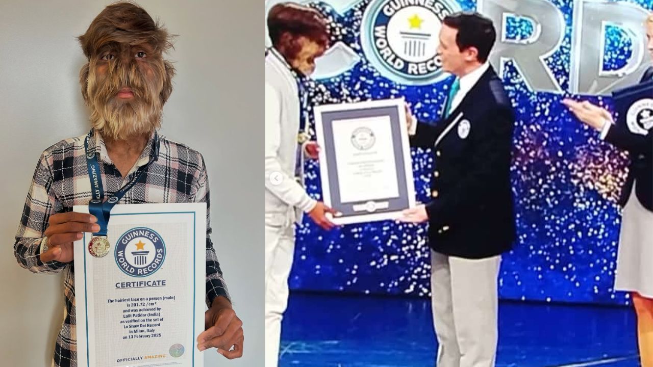 ‘Werewolf Syndrome’: Indian boy secures Guinness World Record for ...