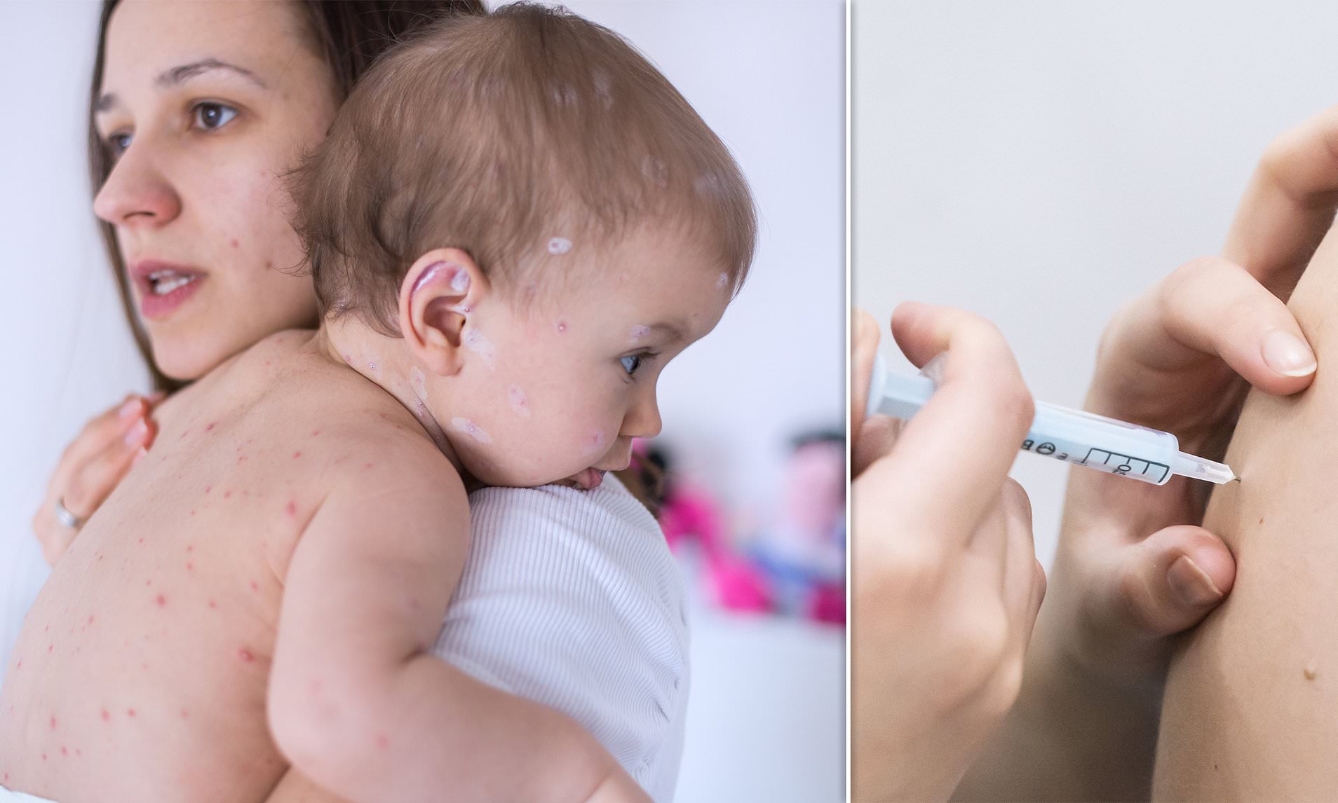 Play centre criticises parents over secret 'chickenpox party' plan