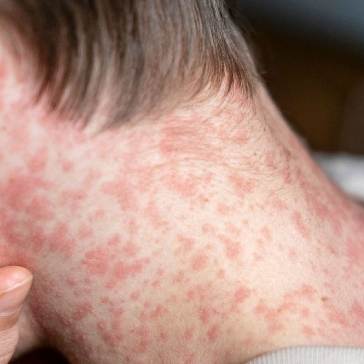 La rougeole explose en France et elle est très contagieuse : voici les ...