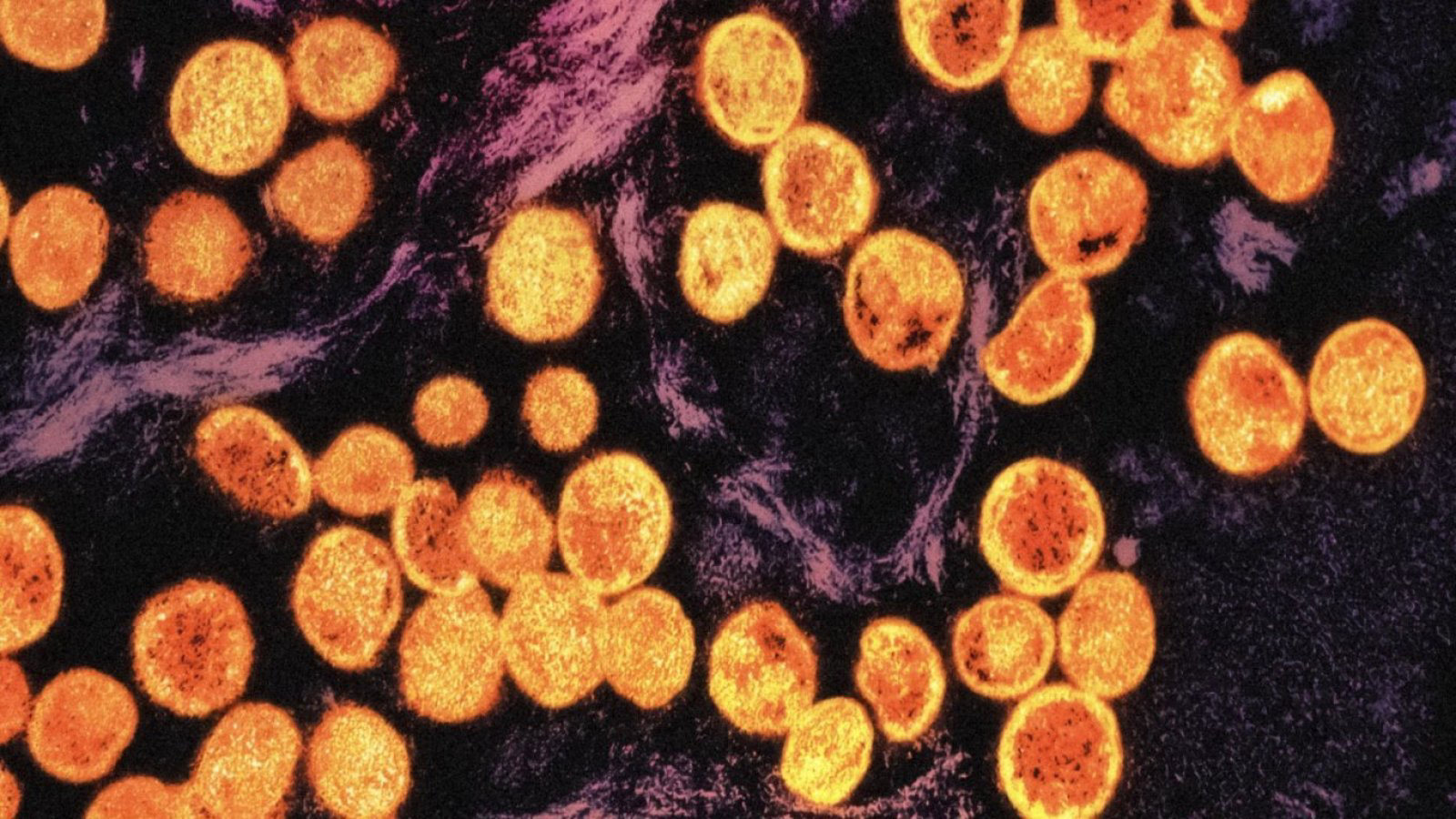 Brasil confirma el primer caso de variante de Mpox que generó mortal ... Brasil confirma el primer caso de variante de Mpox que generó mortal ...