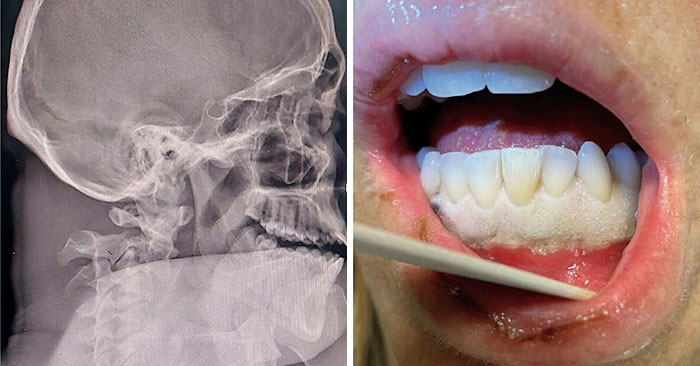 23 Bizarre And Inspiring Medical Cases That People Shared On This ...