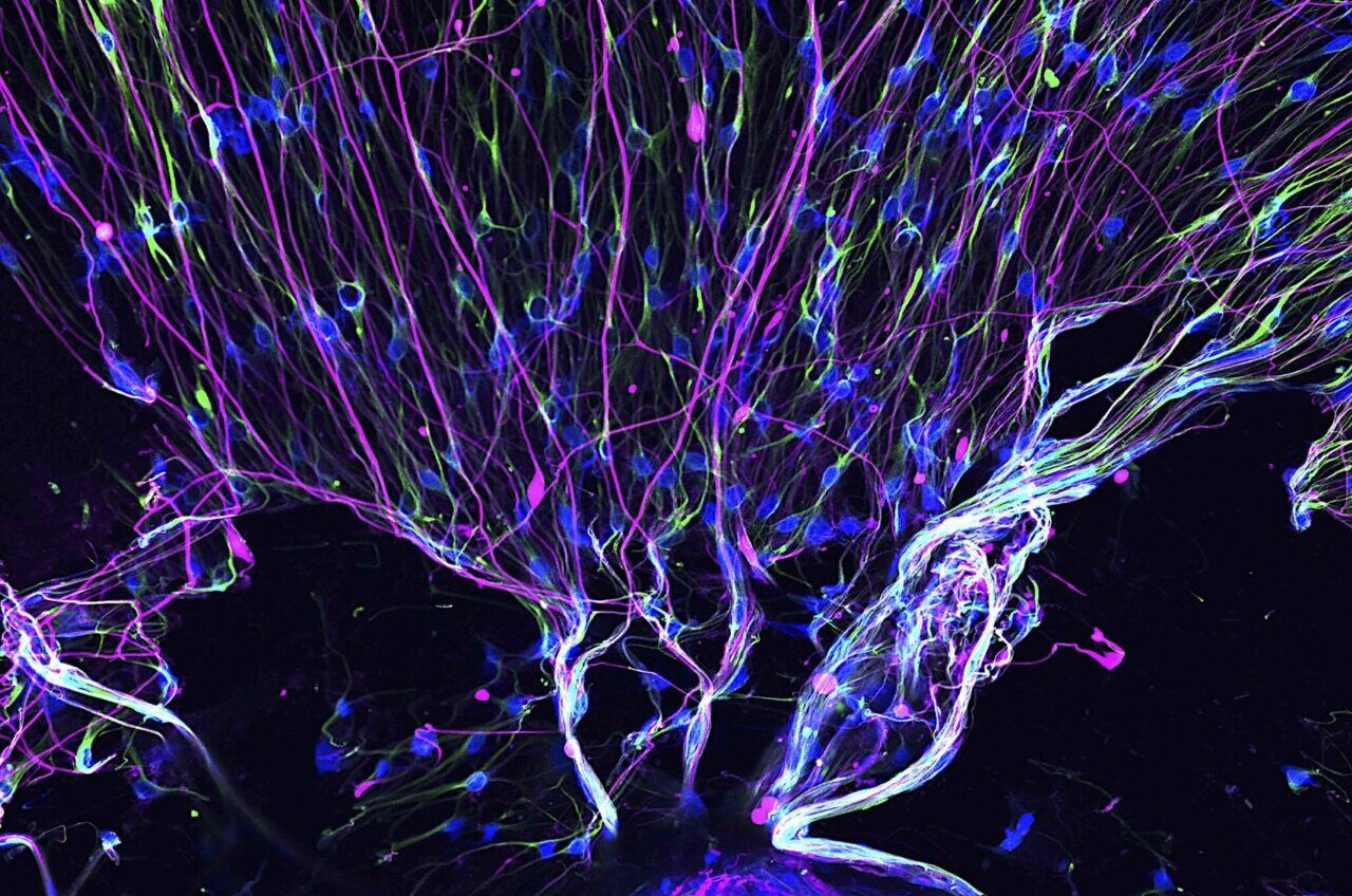 Study shows how neurofilaments act like Velcro to clog up brain functions