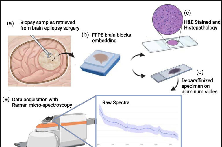 Spectroscopy technique could improve surgery for pediatric epilepsy ...