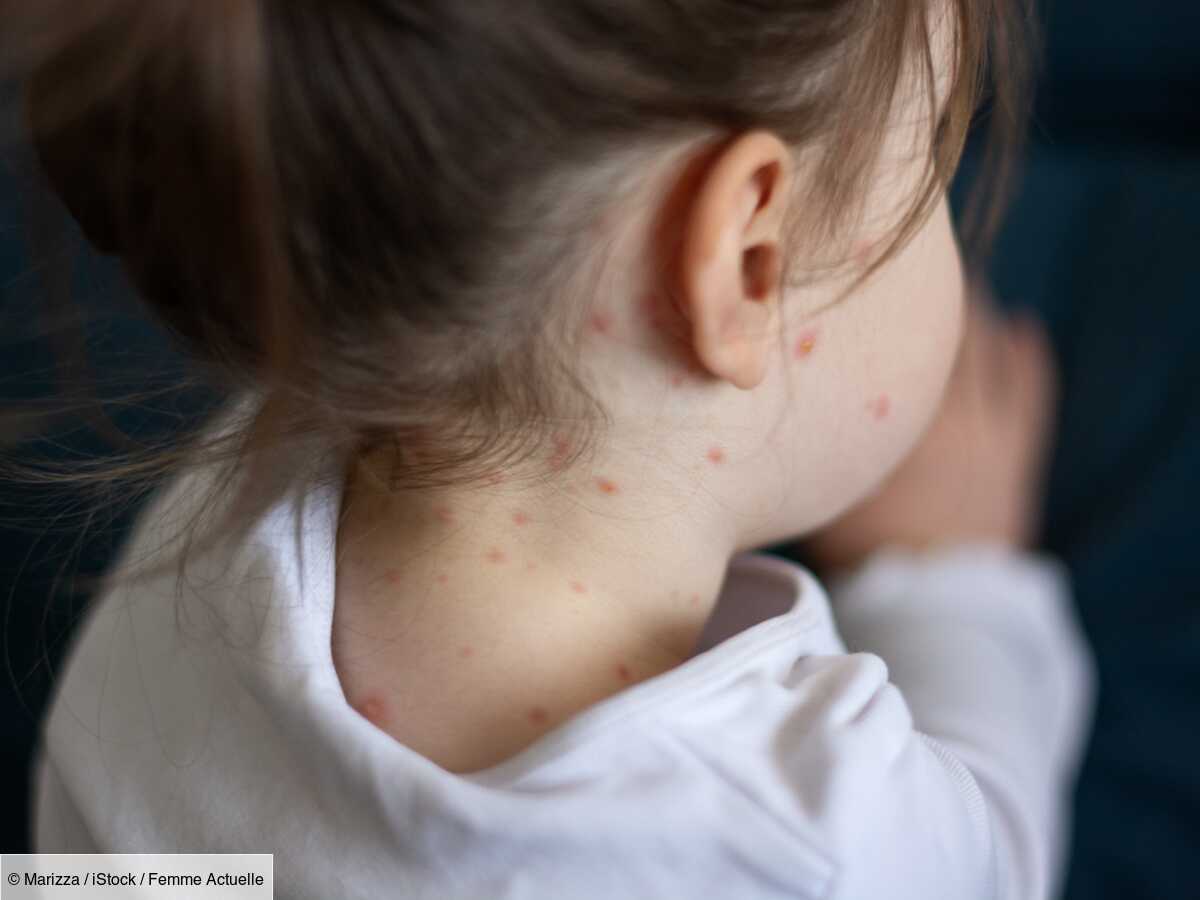 Une recrudescence des cas de rougeole dans les "semaines à venir ...